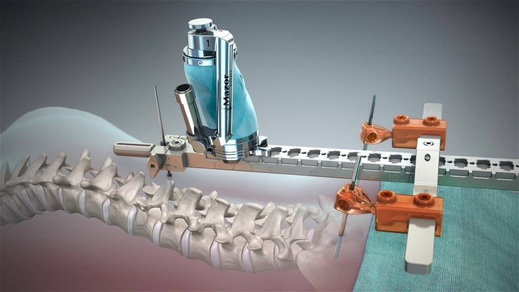Traditional Spine Surgery Versus Robotic Spine Surgery - Details You ...