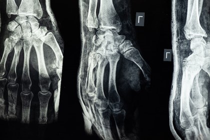 A Brief History of the X-Ray: From Its Invention to the Modern Day ...
