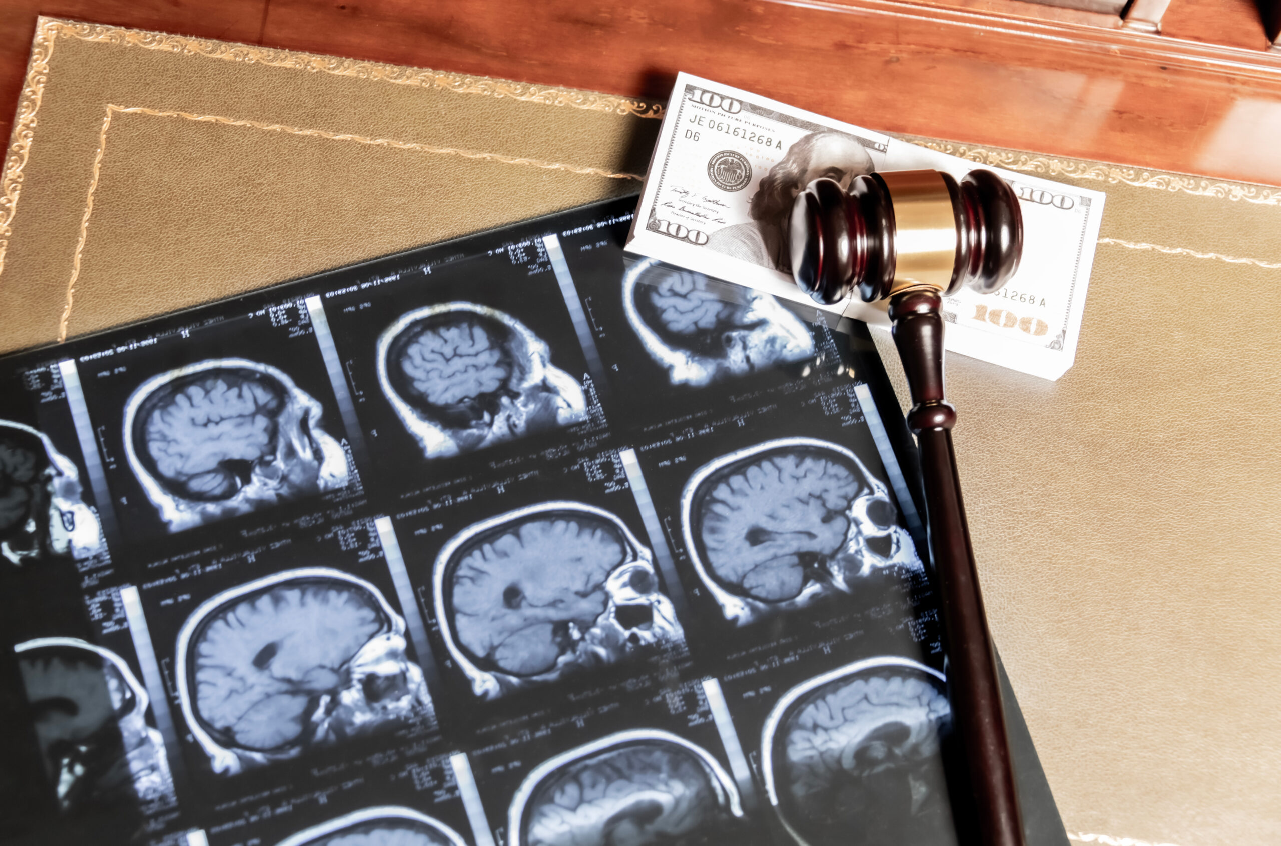 Understanding Damages: How To Calculate A Personal Injury Settlement ...